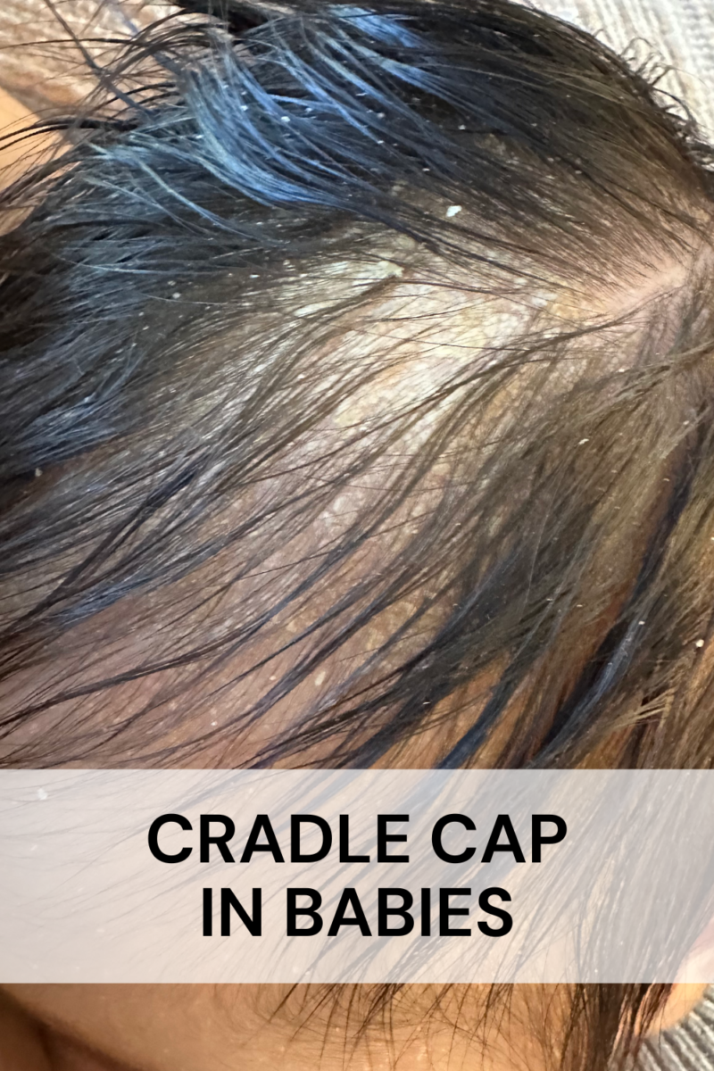 Cradle Cap in babies: What It Is and Treatment - Wisdom For Families